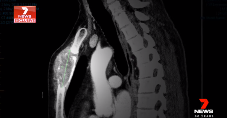 Australian Man Receives 3D Printed Titanium Replacement for Sternum ...